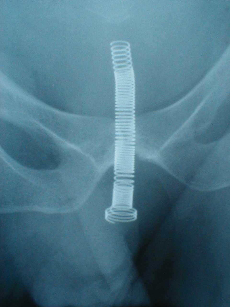 Long-term result of Memokath urethral sphincter stent in spinal cord ...
