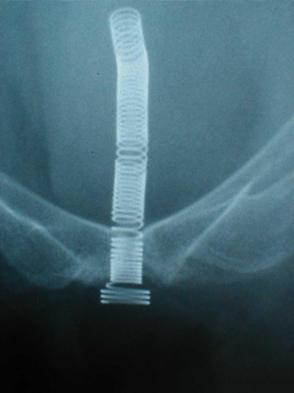 Long-term result of Memokath urethral sphincter stent in spinal cord ...