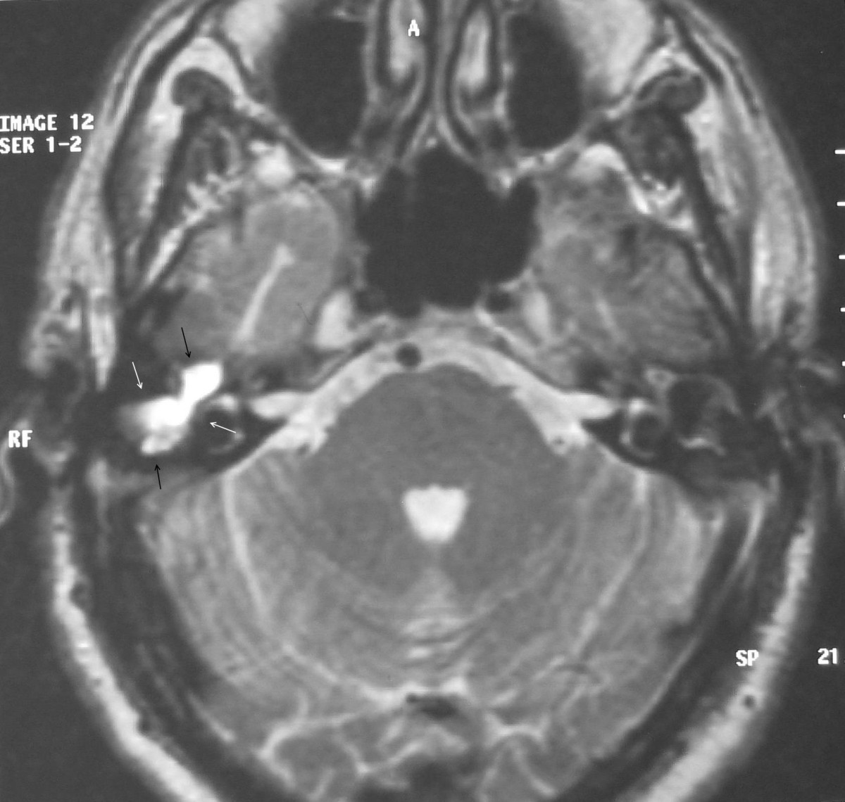 Cholesterol granuloma presenting as a mass obstructing the external ear ...