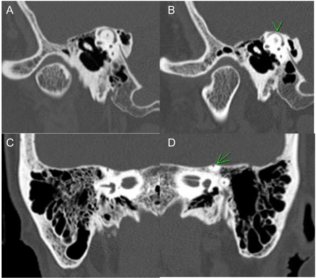 Superior semicircular canal dehiscence in East Asian women with ...
