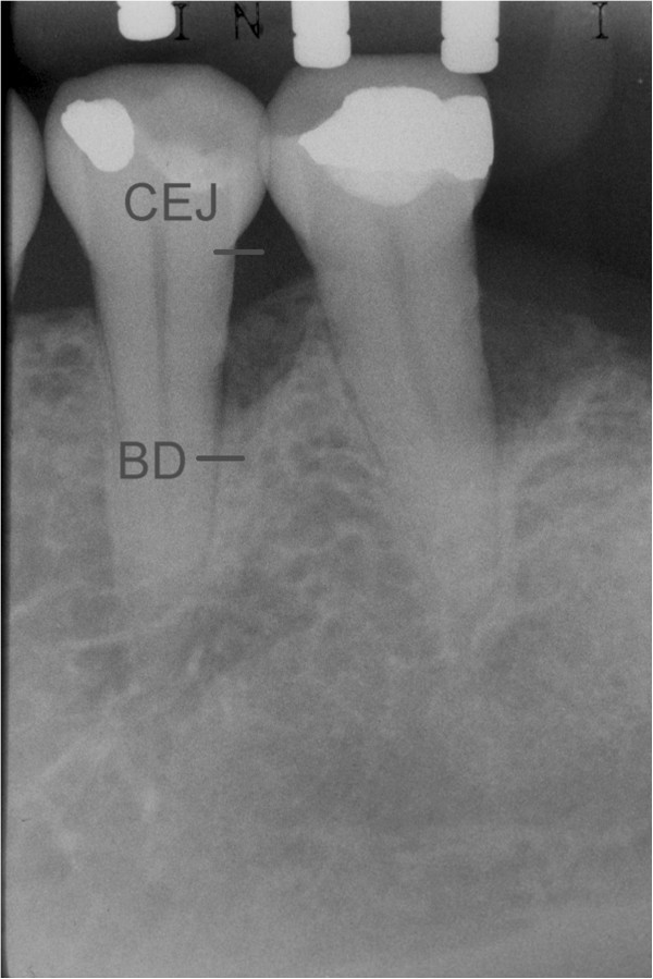 Two-year randomized clinical trial of enamel matrix derivative treated ...