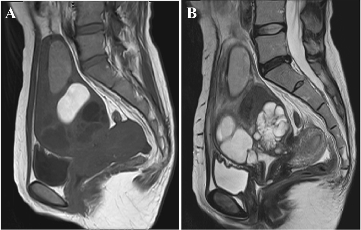 Huge pyogenic cervical cyst with endometriosis, developing 13 years ...