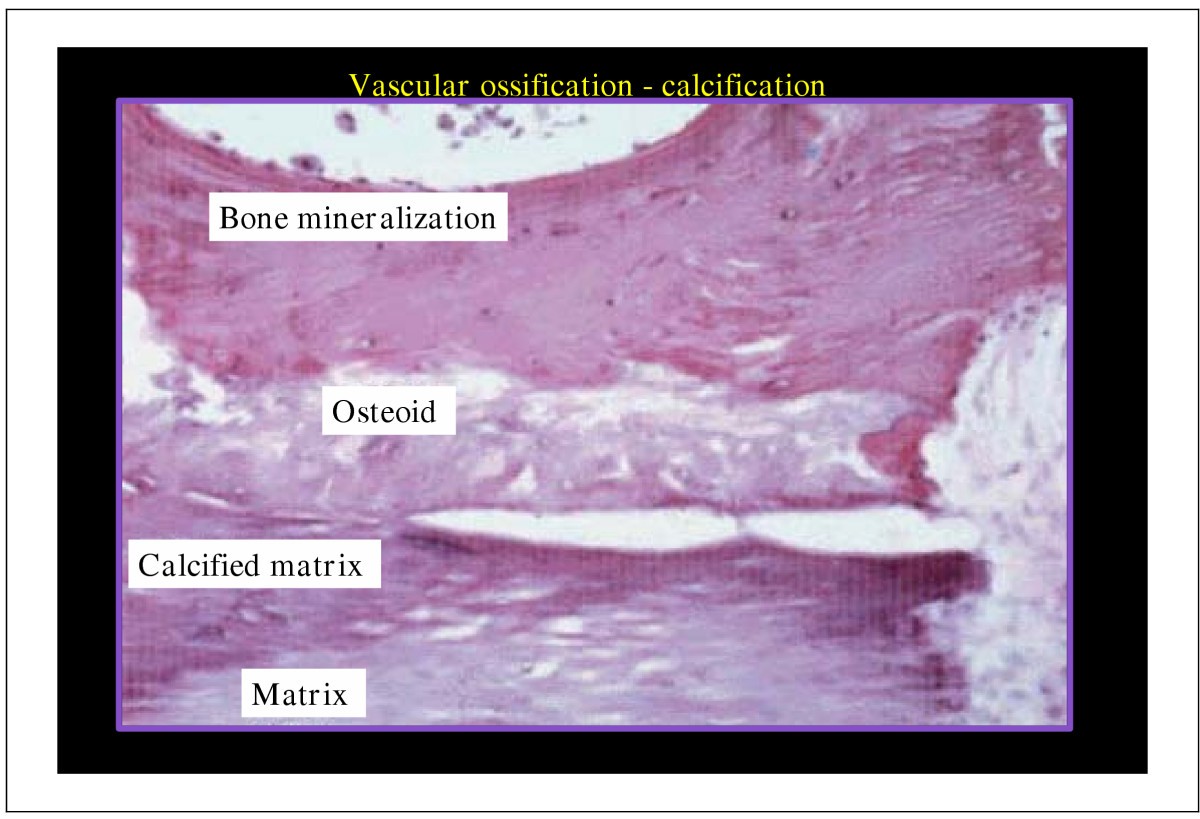 Vascular ossification – calcification in metabolic syndrome, type 2 ...