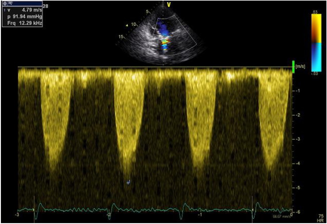 Orthostatic stress echocardiography as a useful test to measure ...