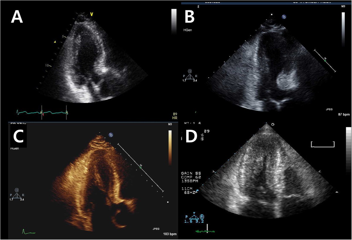 Diverse geometric changes related to dynamic left ventricular outflow ...