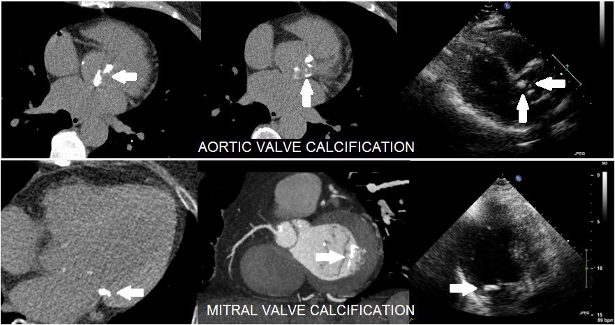 Cardiac calcium score on 2D echo: correlations with cardiac and ...
