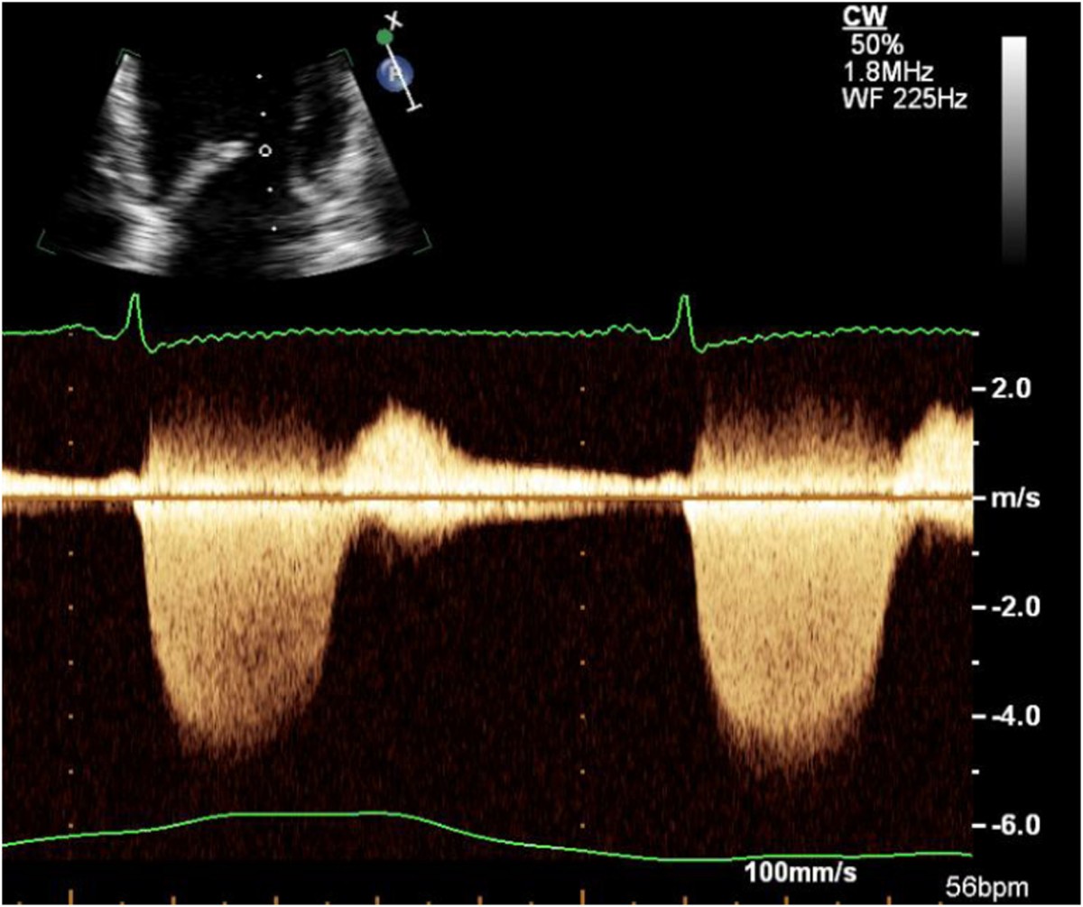 Echocardiographic assessment of ischemic mitral regurgitation ...