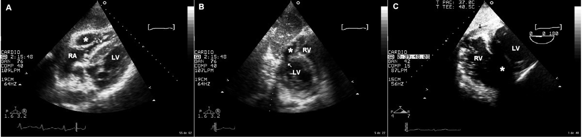 Septal rupture with right ventricular wall dissection after myocardial ...