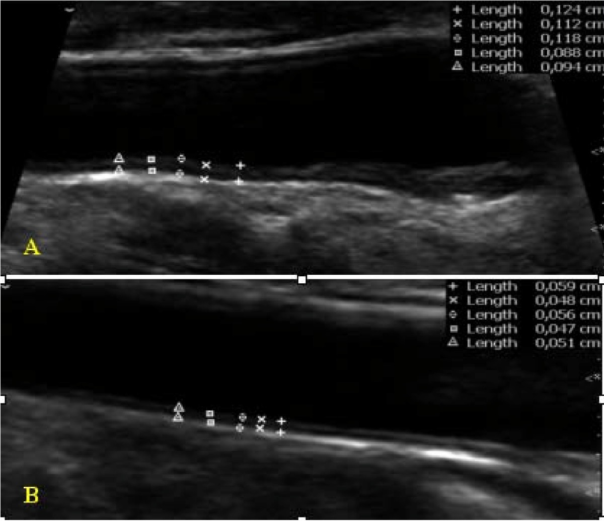 Appropriateness of carotid plaque and intima-media thickness assessment ...