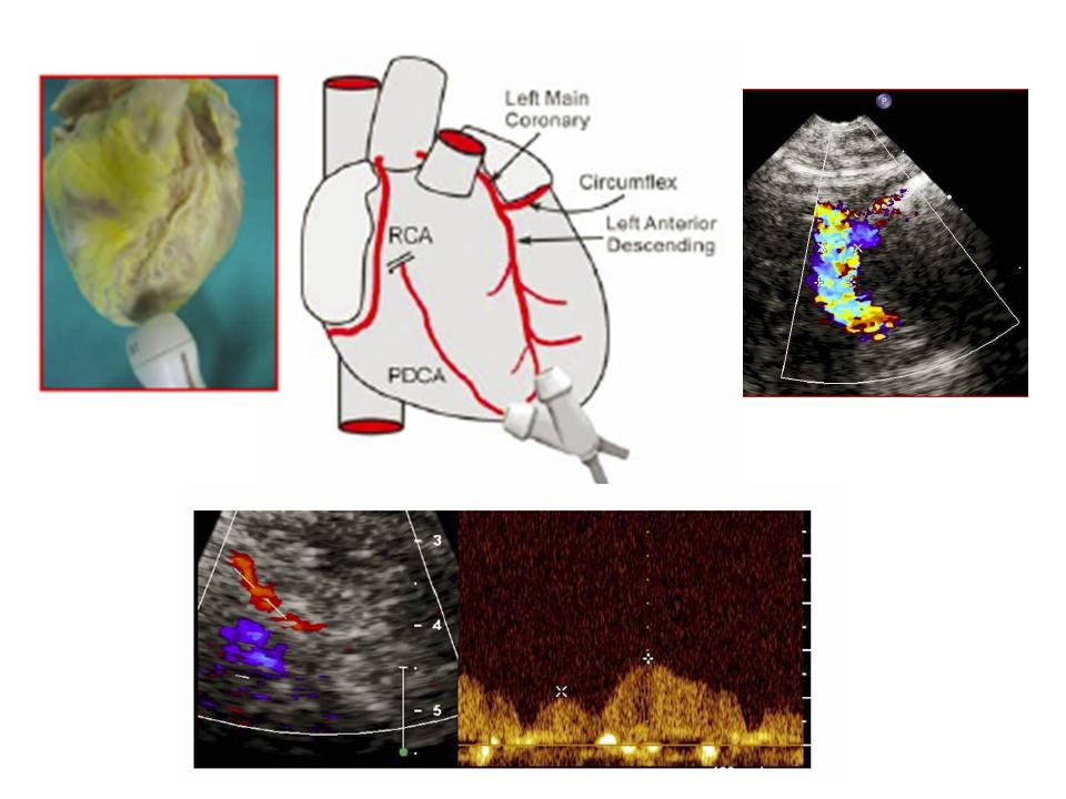 Transthoracic echocardiographic imaging of coronary arteries: tips ...