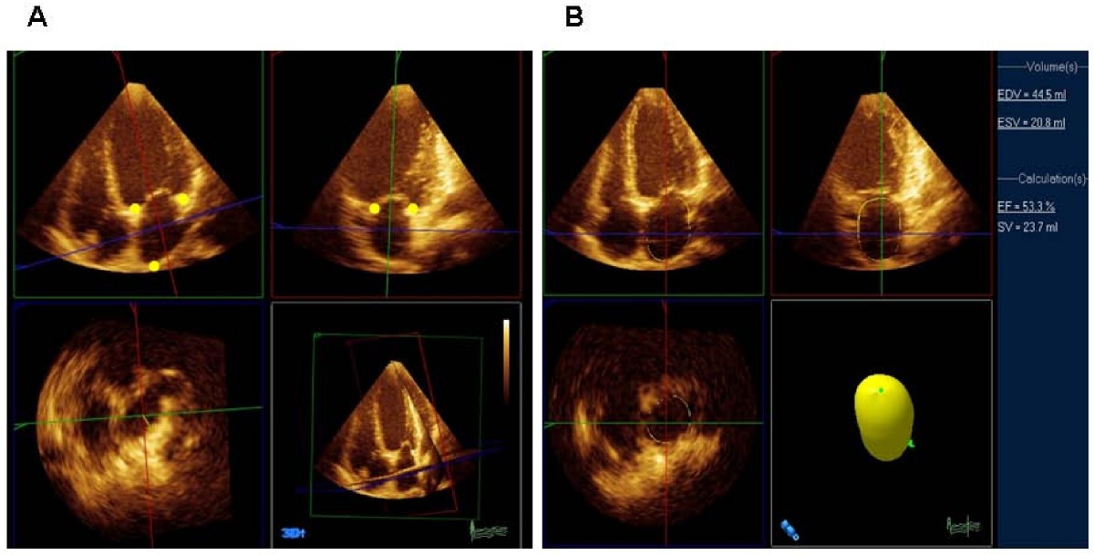 Left atrial volume measurement with automated border detection by 3 ...