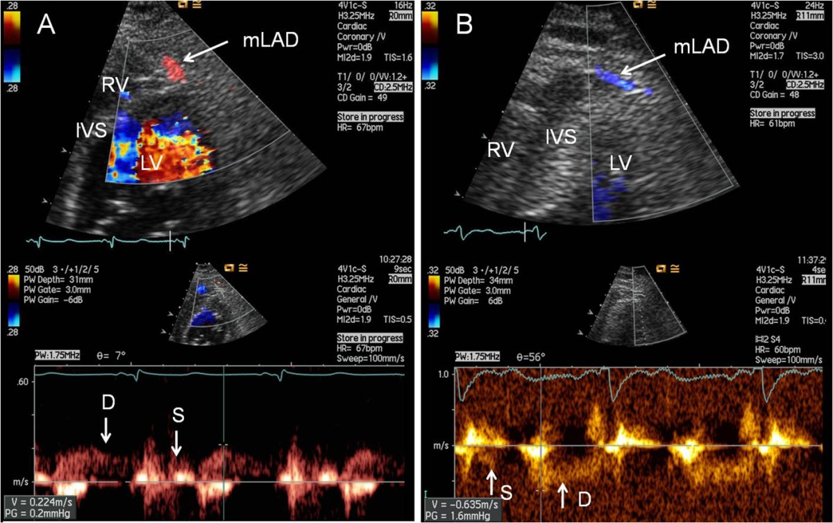 Transthoracic echocardiography for imaging of the different coronary ...
