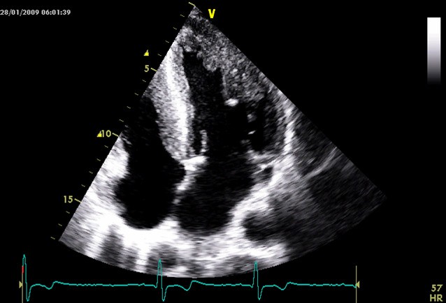 Echocardiography in patients with hypertrophic cardiomyopathy ...