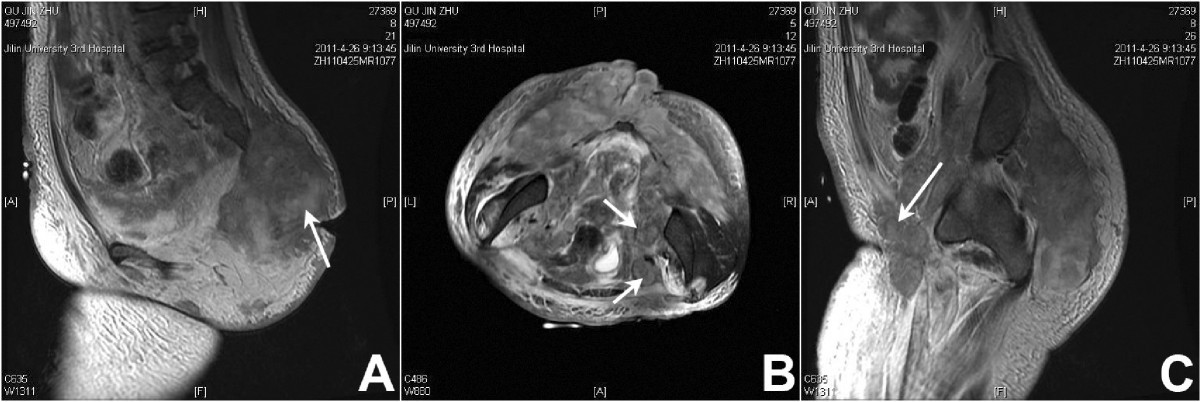 Synovial sarcoma of the buttocks presenting with a non-healing wound ...