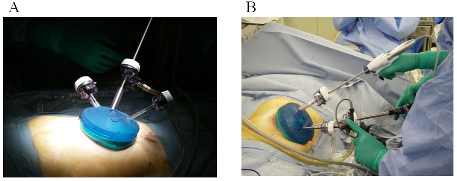 Single-port laparoscopic colectomy versus conventional laparoscopic colectomy for colon cancer ...