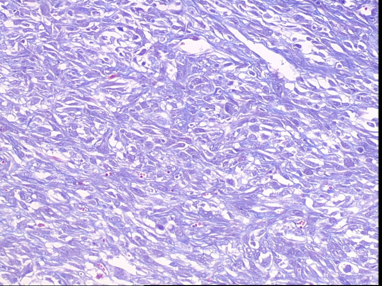 Neurofibrosarcoma of the gallbladder: a case report | World Journal of ...