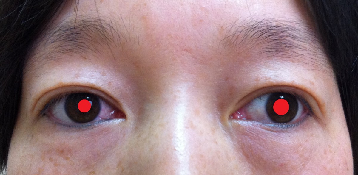 Postoperative Horner’s syndrome after video-assisted thyroidectomy: a ...