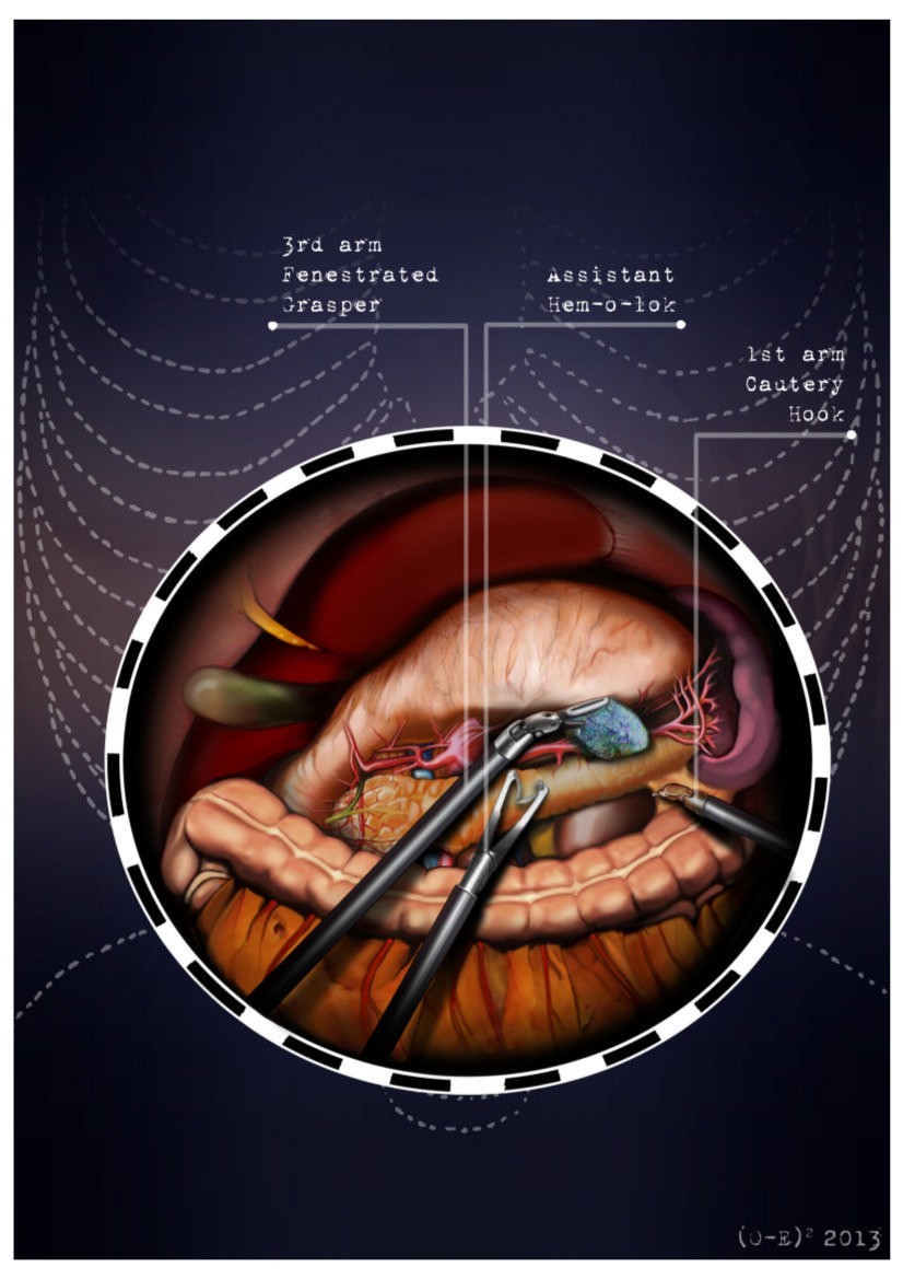 Robotic distal pancreatectomy with or without preservation of spleen: a technical note | World ...