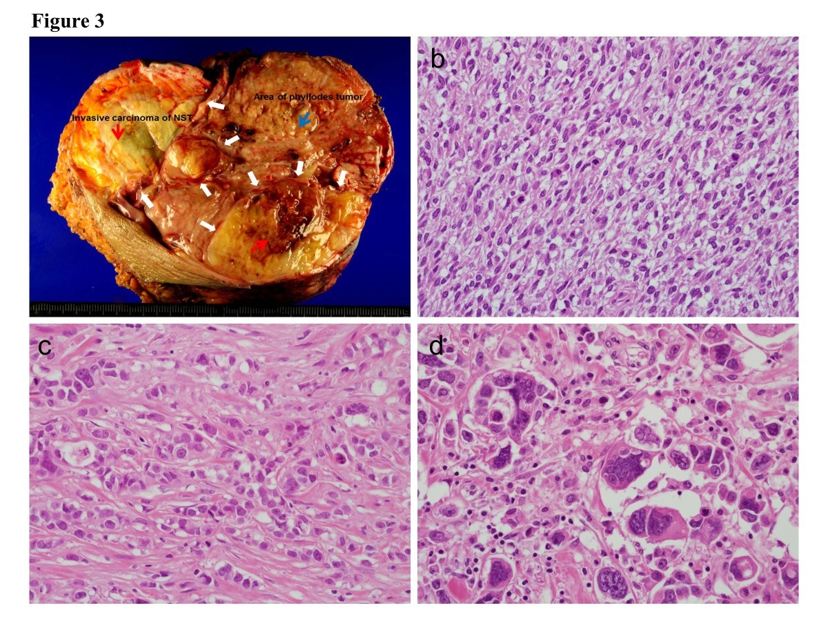 Collision tumor with inflammatory breast carcinoma and malignant ...