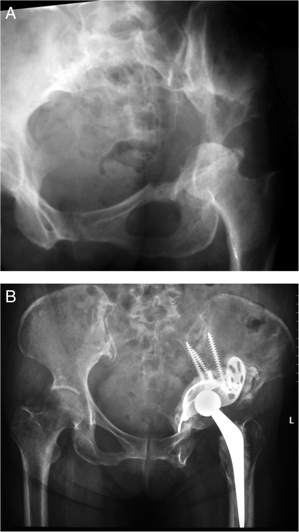 Functional outcome and complications following reconstruction for ...