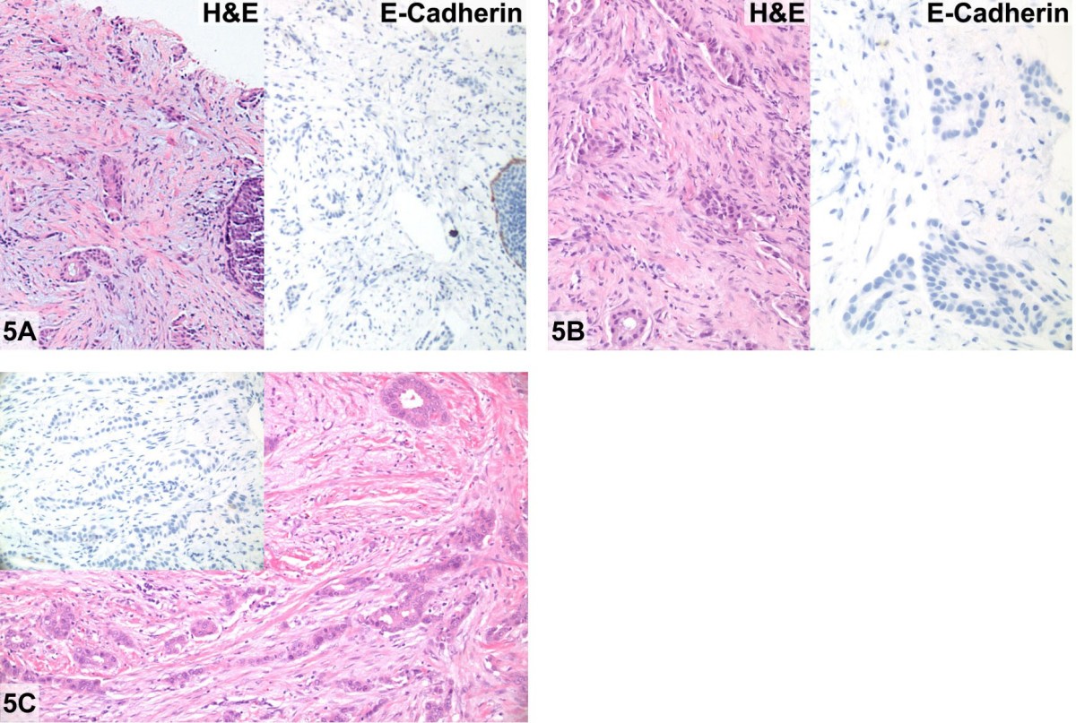 Aberrant E-cadherin staining patterns in invasive mammary carcinoma ...
