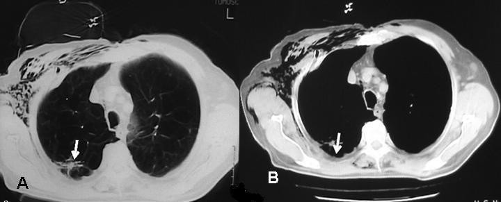 A rare tumoral combination, synchronous lung adenocarcinoma and mantle ...