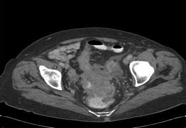 Clostridium septicum sepsis and colorectal cancer - a reminder | World ...