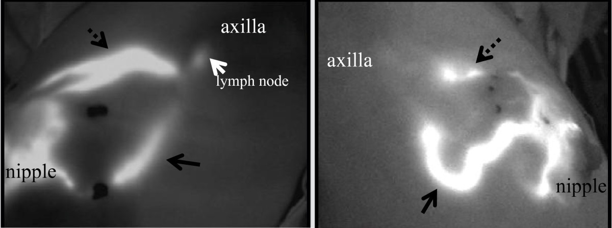 Sentinel lymph node biopsy for breast cancer patients using ...