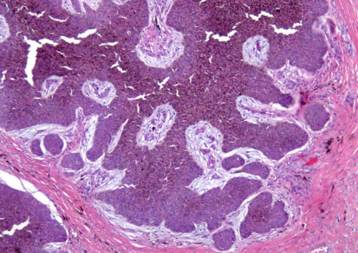 Eccrine porocarcinoma of the lower extremity: A case report and review ...