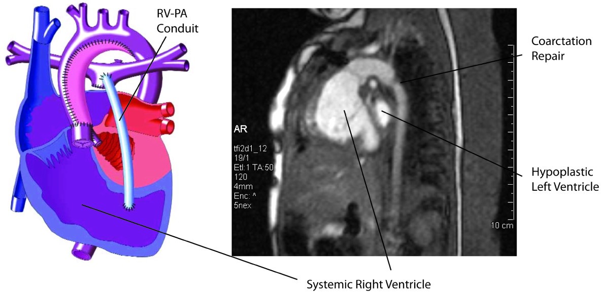 Cardiovascular magnetic resonance of pulmonary artery growth and ...