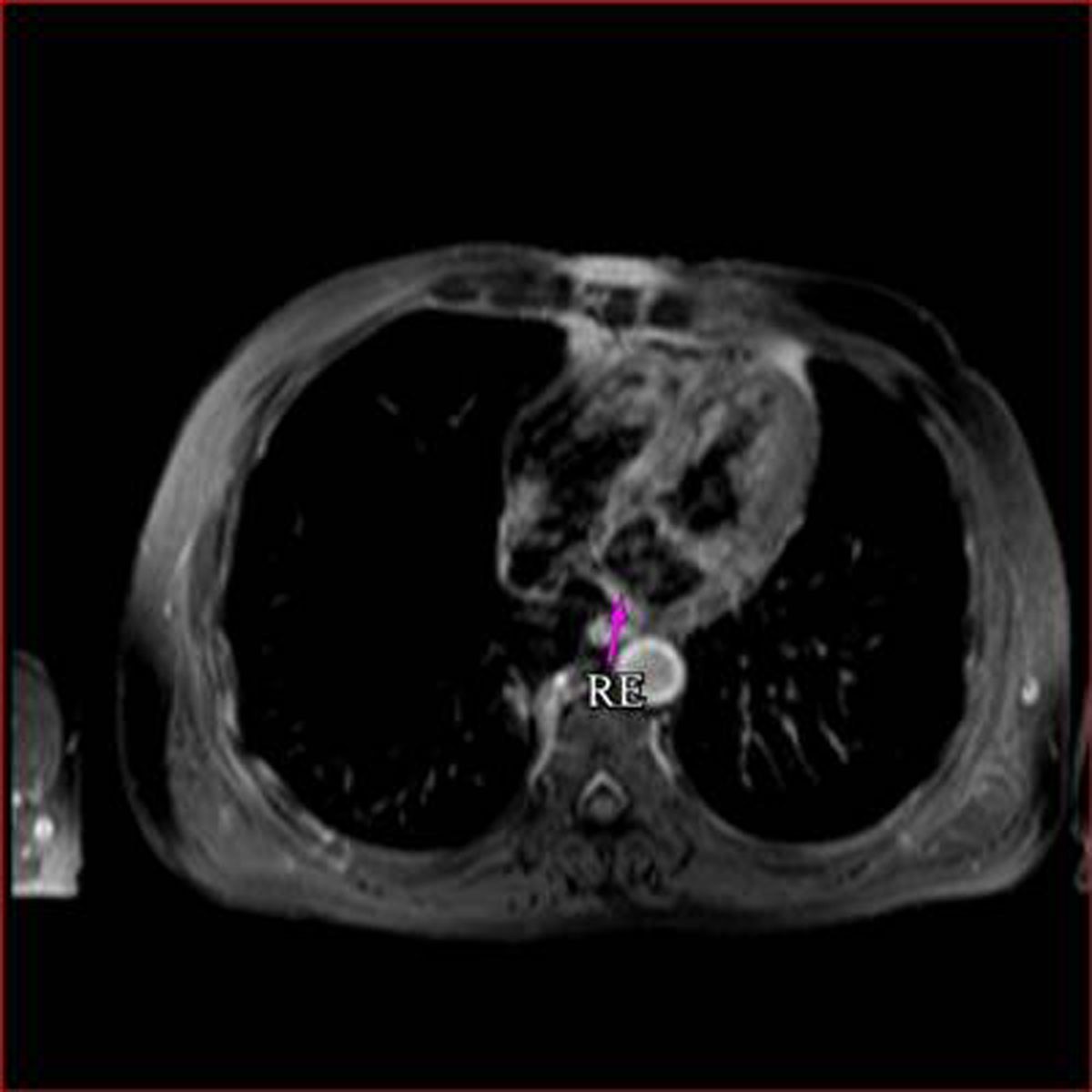 MRI image sequencing of calcified myocardial masses: liquefaction ...