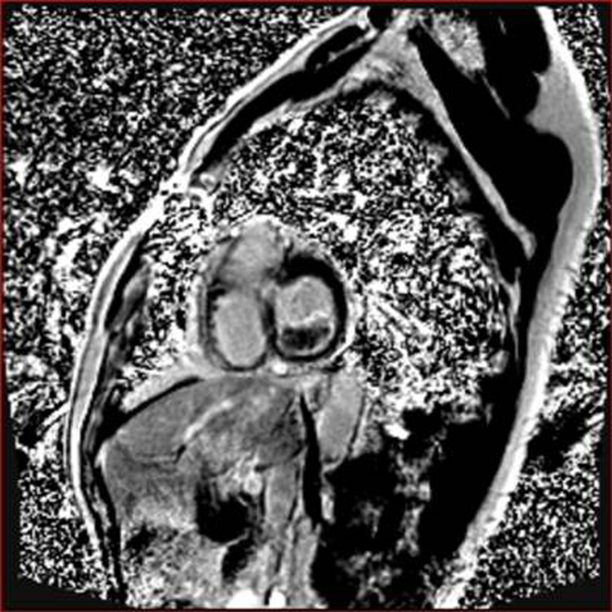 MRI image sequencing of calcified myocardial masses: liquefaction ...