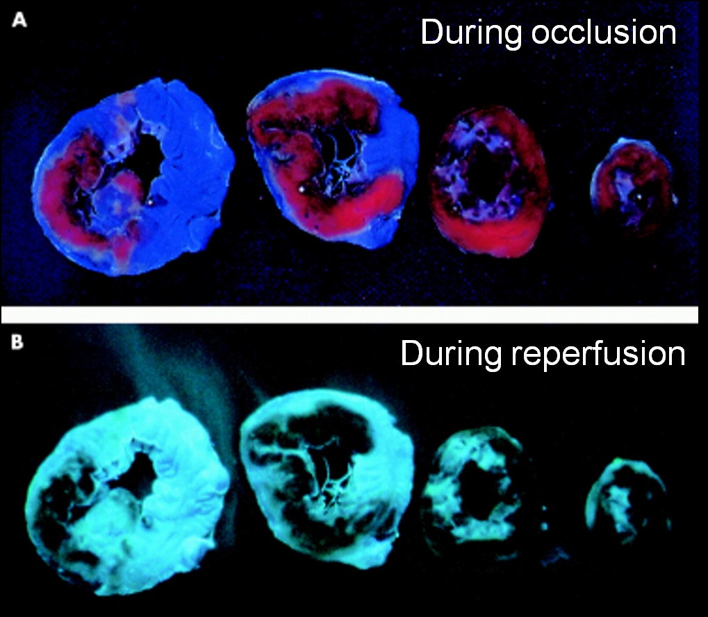 CMR of microvascular obstruction and hemorrhage in myocardial ...
