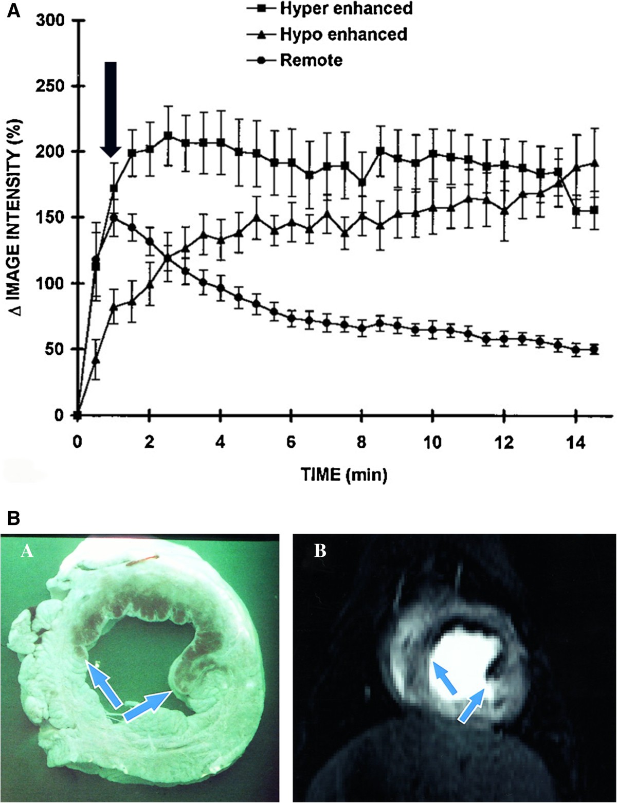 CMR of microvascular obstruction and hemorrhage in myocardial ...