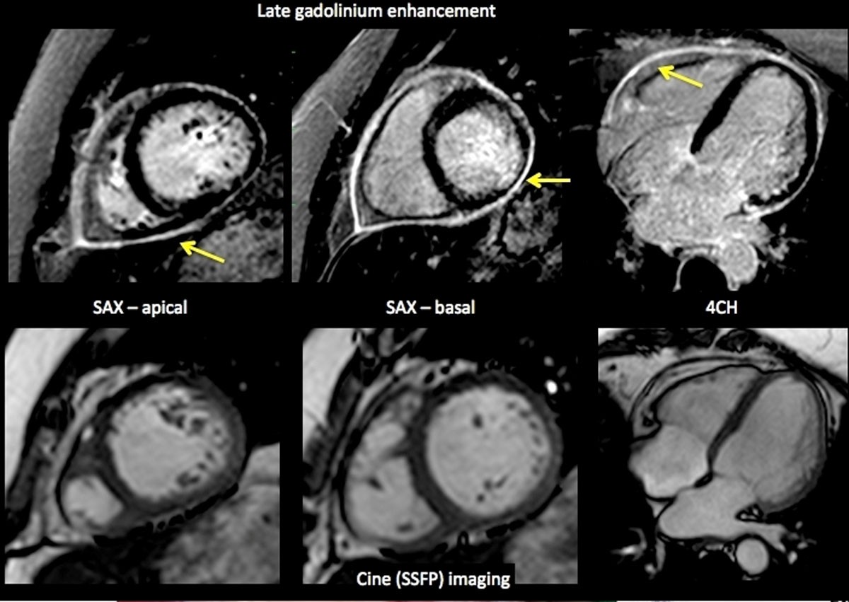 Native T1 mapping by cardiovascular resonance imaging detects ...