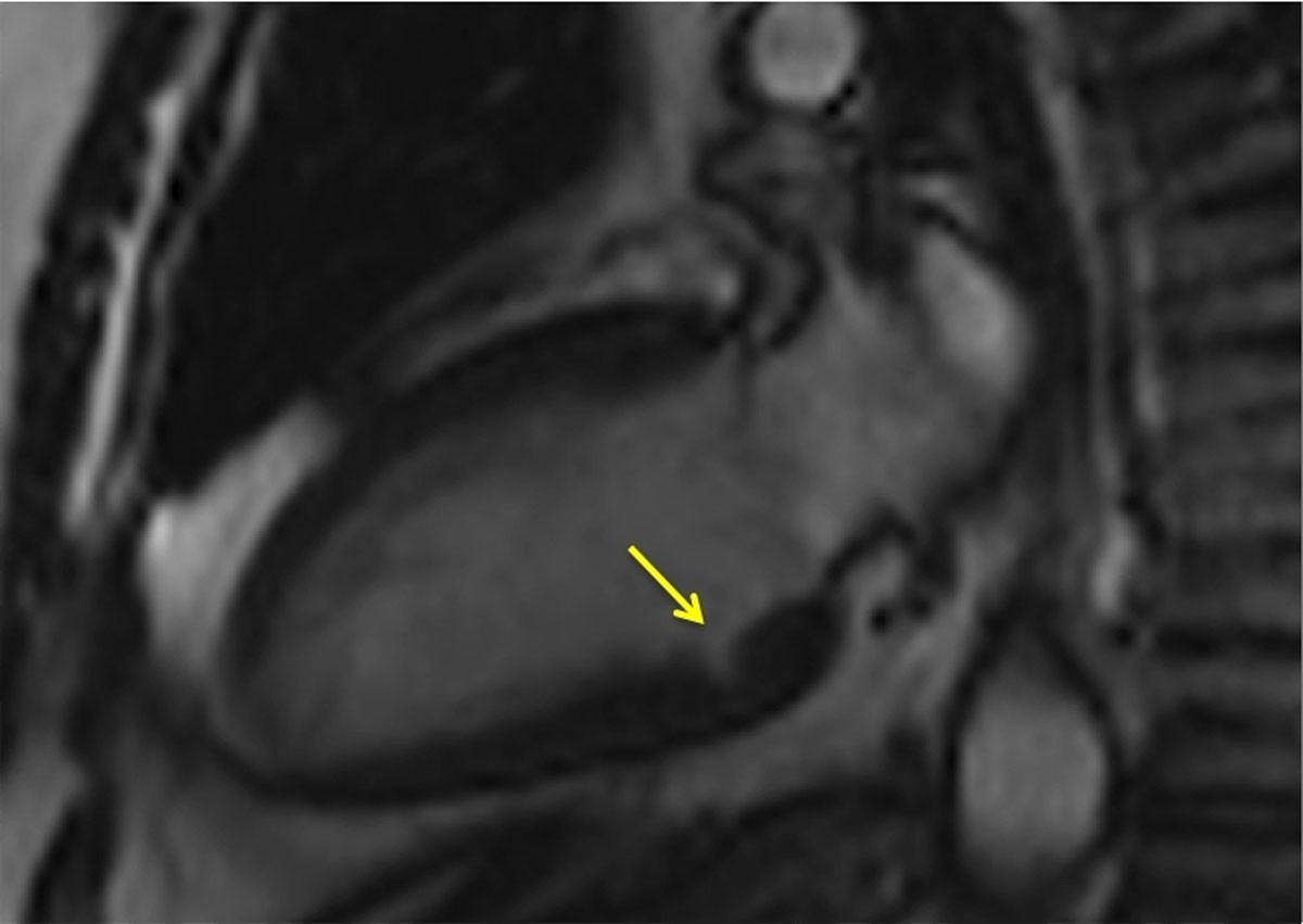 Prevalence of myocardial crypts in a cardiac magnetic resonance ...