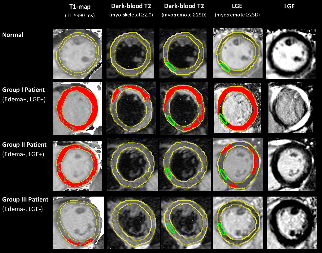 Native T1-mapping detects the location, extent and patterns of acute ...