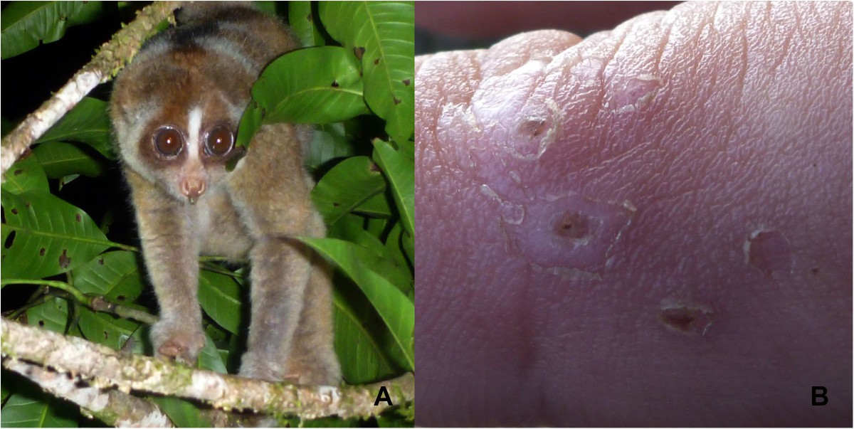 Anaphylactic shock following the bite of a wild Kayan slow loris (Nycticebus kayan ...