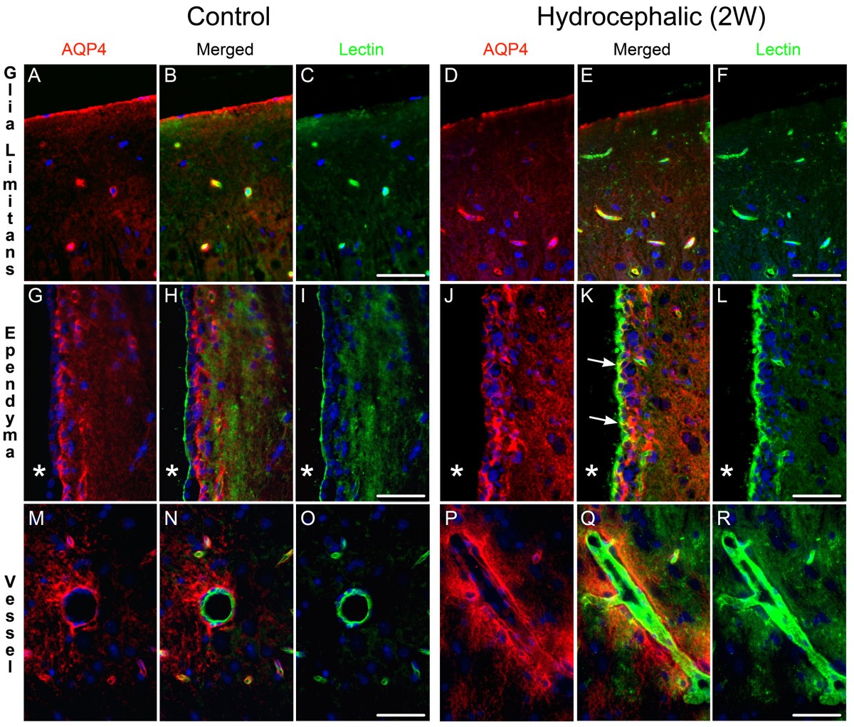 Hydrocephalus induces dynamic spatiotemporal regulation of aquaporin-4 expression in the rat ...