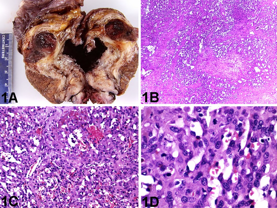 Primary angiosarcoma of the testis: report of a rare entity and review ...