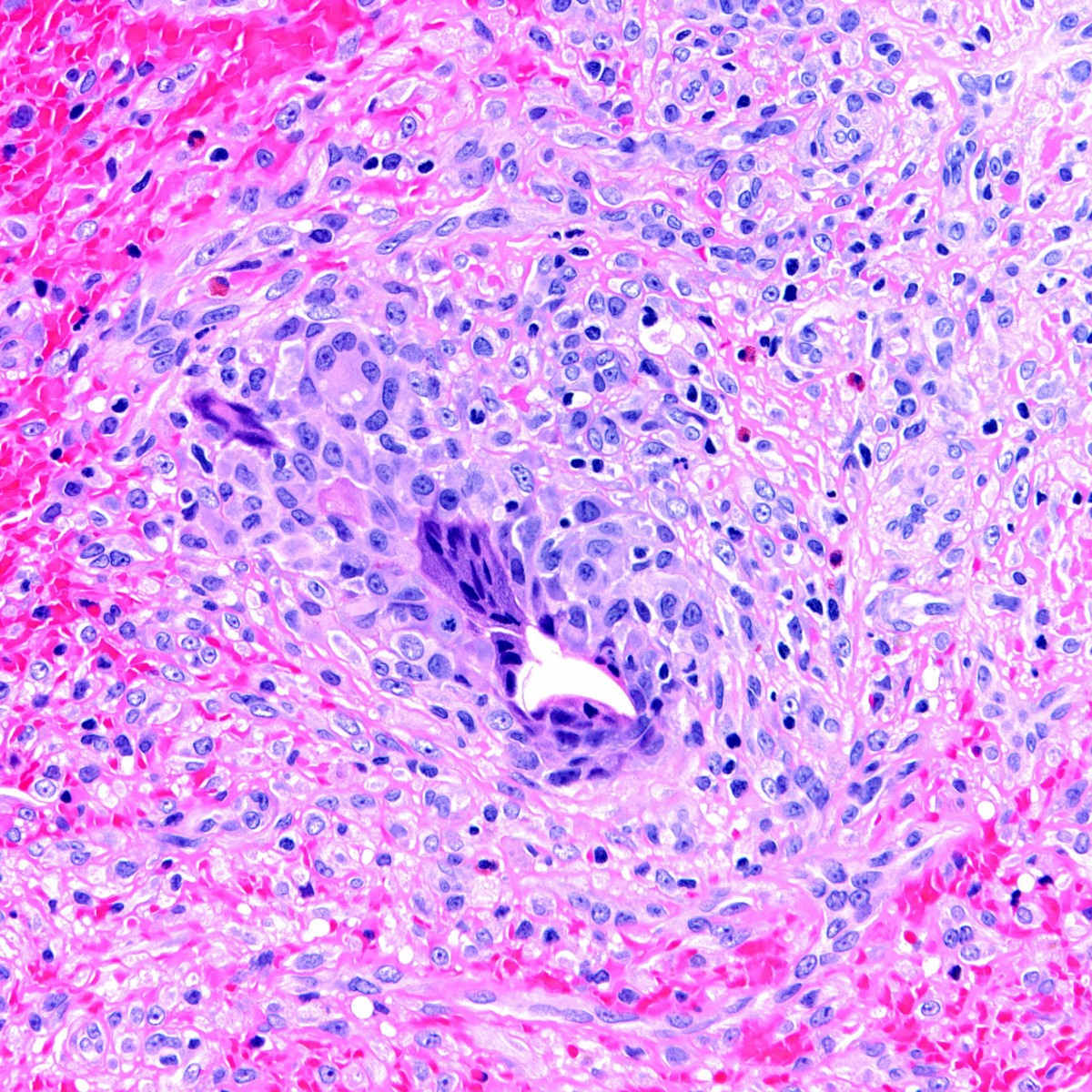Intravascular lesions of the hand | Diagnostic Pathology | Full Text