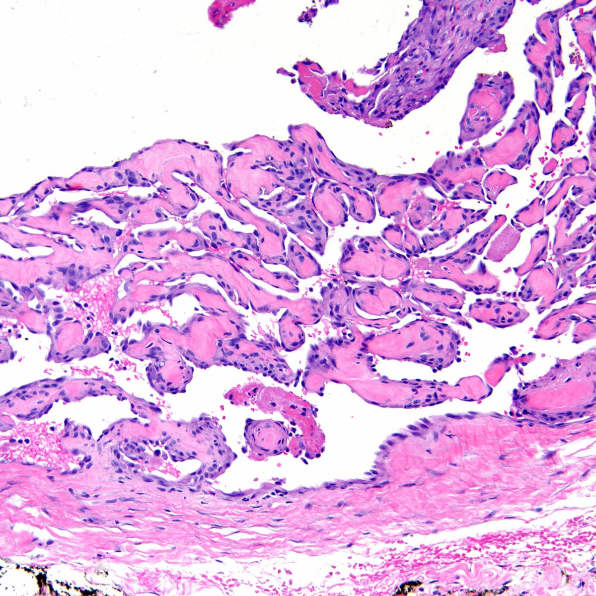Intravascular lesions of the hand | Diagnostic Pathology | Full Text