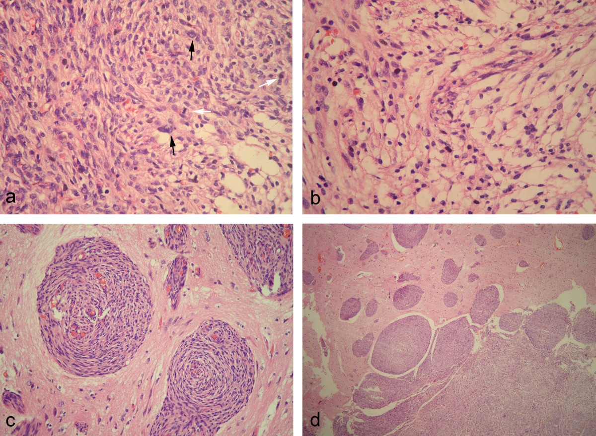 Sporadic meningioangiomatosis-associated atypical meningioma mimicking ...