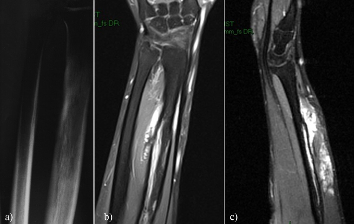 Epithelioid hemangioendothelioma of the forearm with radius involvement ...