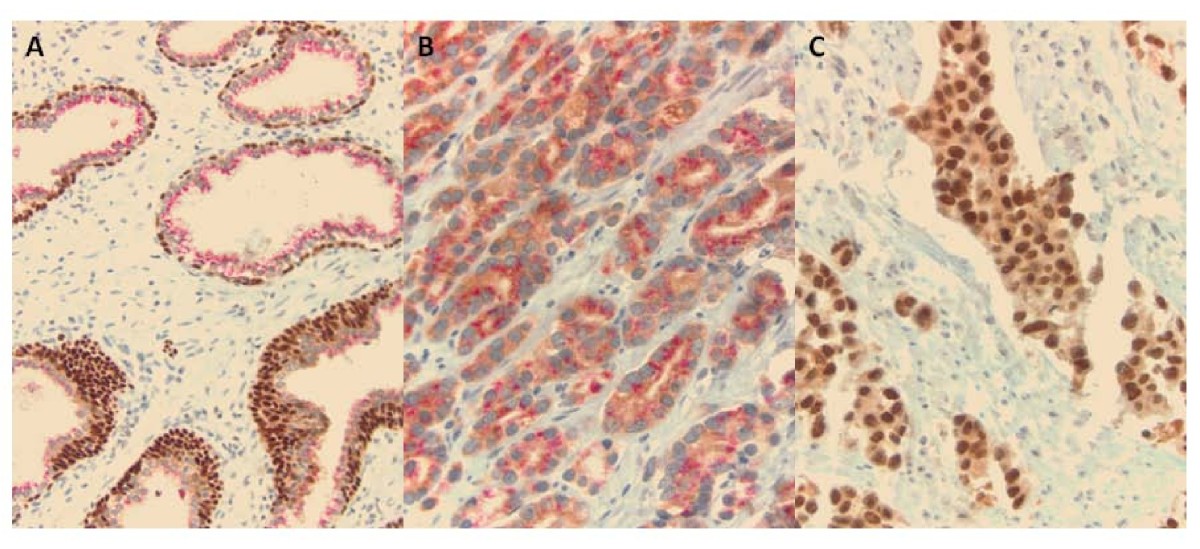 Diagnostic utility of p63/P501S double sequential immunohistochemical ...