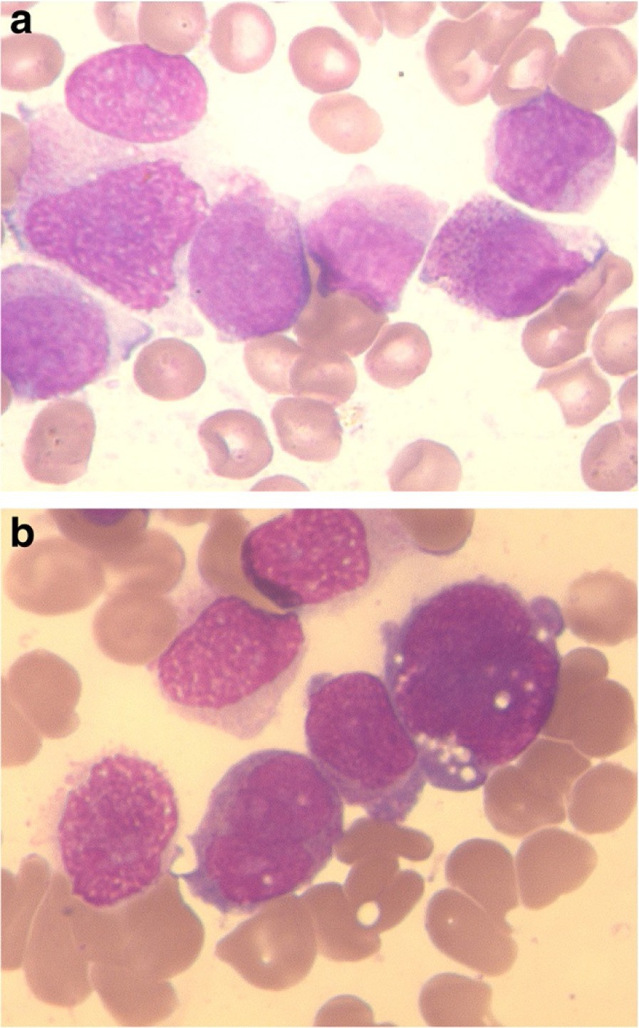 Apl Morphology - Hypergranular Promyelocytic Leukemia Correlation ...