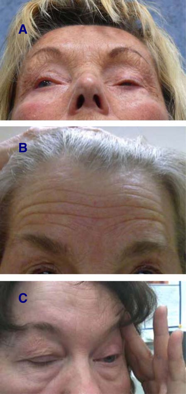 Frontalis suspension surgery to treat patients with essential ...