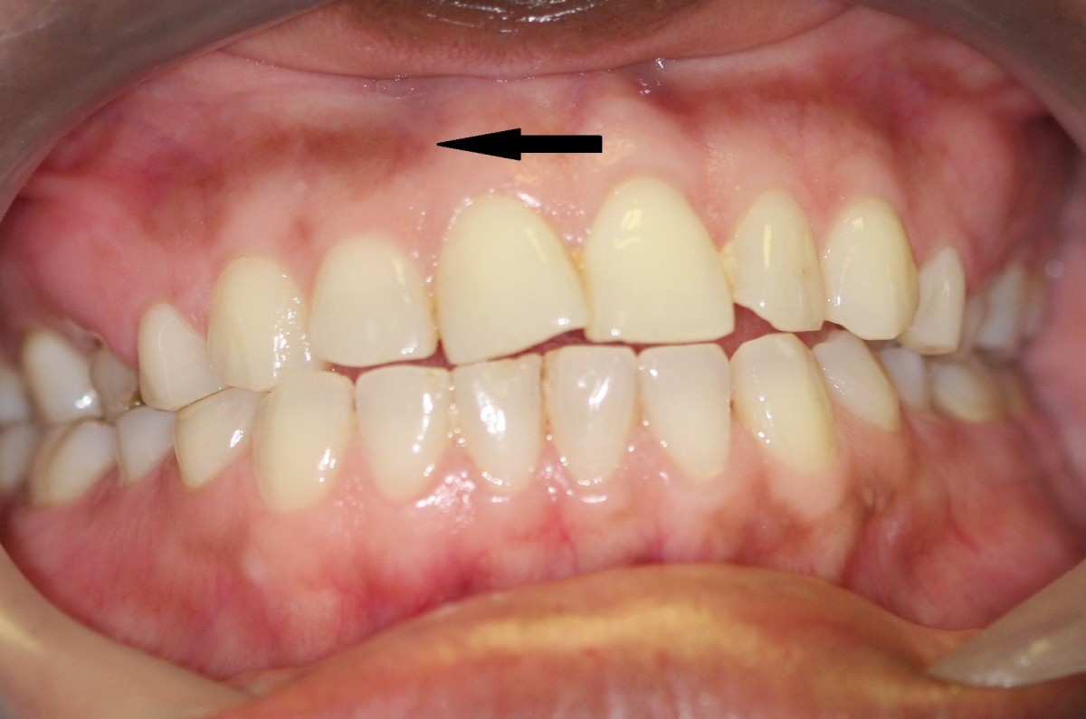Melanin: the biophysiology of oral melanocytes and physiological oral ...