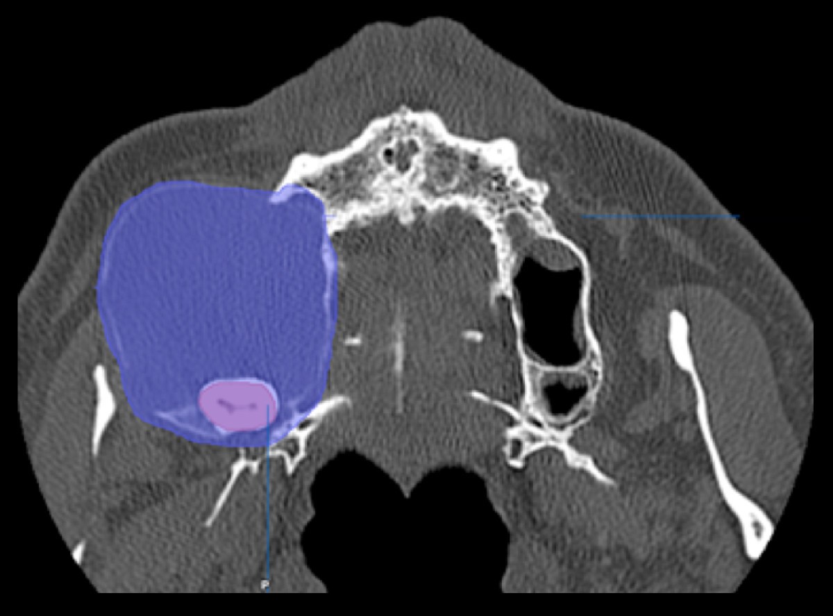 Reconstruction of defects of maxillary sinus wall after removal of a ...