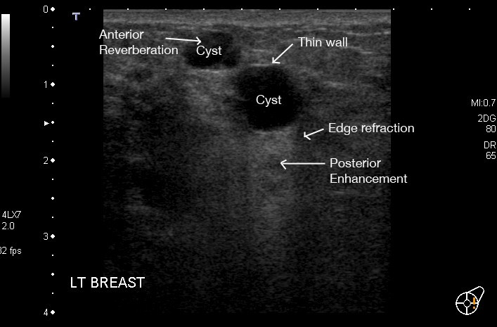 Ultrasound imaging of the lactating breast: methodology and application ...